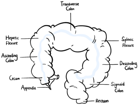 Colorectal Cancer In malaysia | Signs And Symtoms Of Colon Cancer